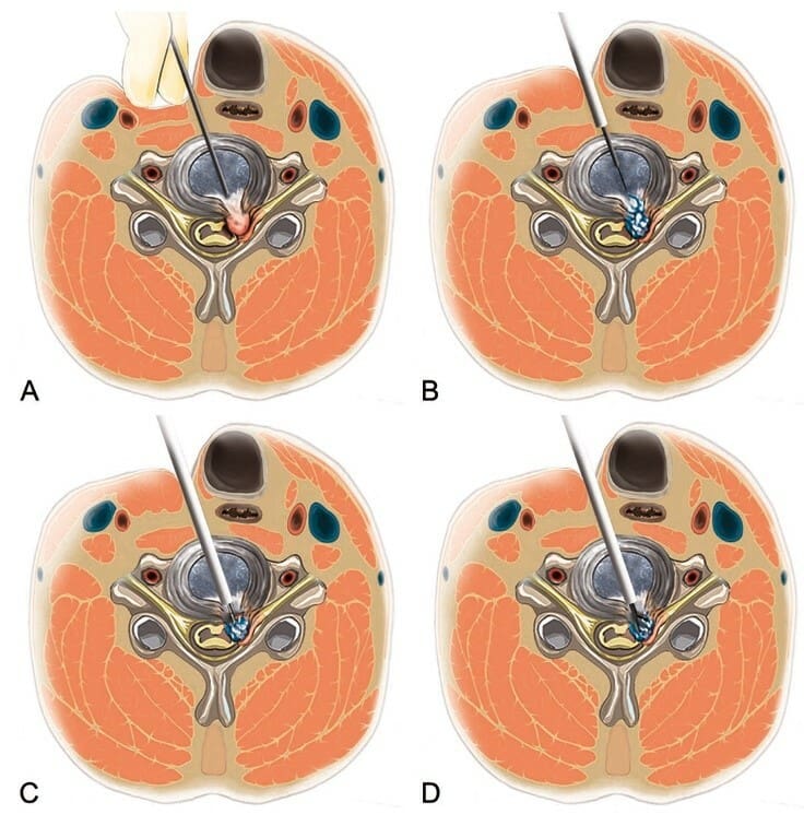 Promising New Advances In Disc Protrusion Treatment